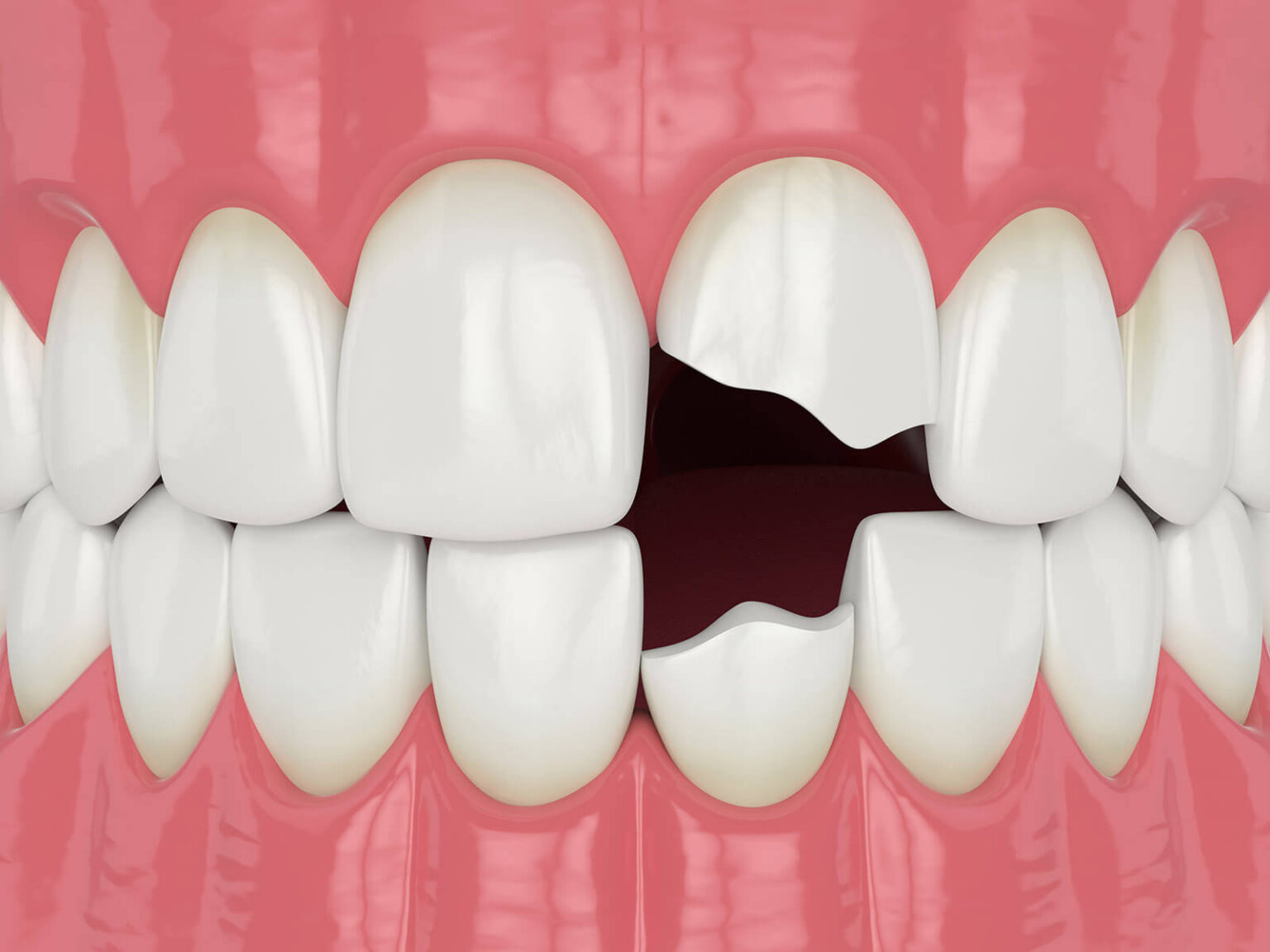 Is Chipped Tooth a Dental Emergency: Liberty Dental Office TX